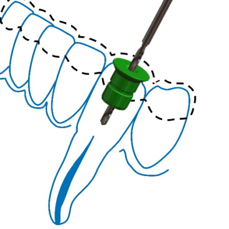 sleeves for guided surgery – Steco