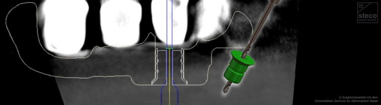 Guided Endo – Steco